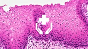 Epithelial Cell Abnormality: Causes Symptoms and Treatment