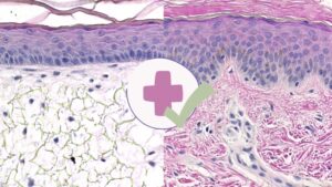 Epithelial Cell Abnormality: Causes Symptoms and Treatment