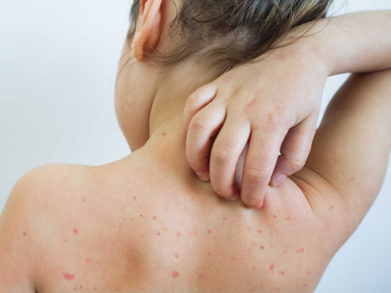 What is Measles? Understanding the Risks and Prevention Strategies ...