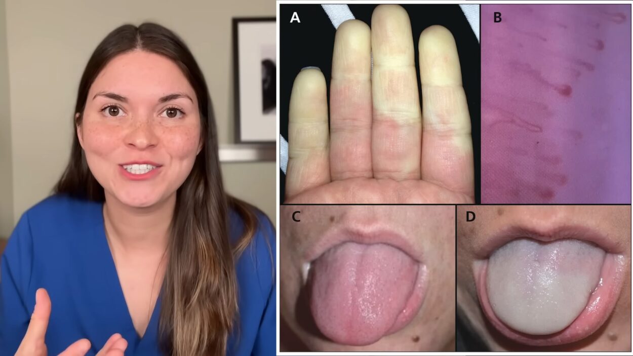 Purple Tongue Causes Including Spots, Under Tongue Veins & Bumps