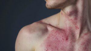 Rash on Chest Pictures, Causes, Symptoms, Remedies and Treatment